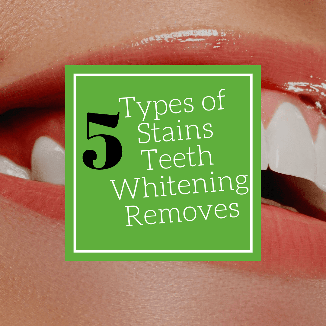 5 Types of Stains Teeth Whitening Removes - Appletree DentistryTigard ...
